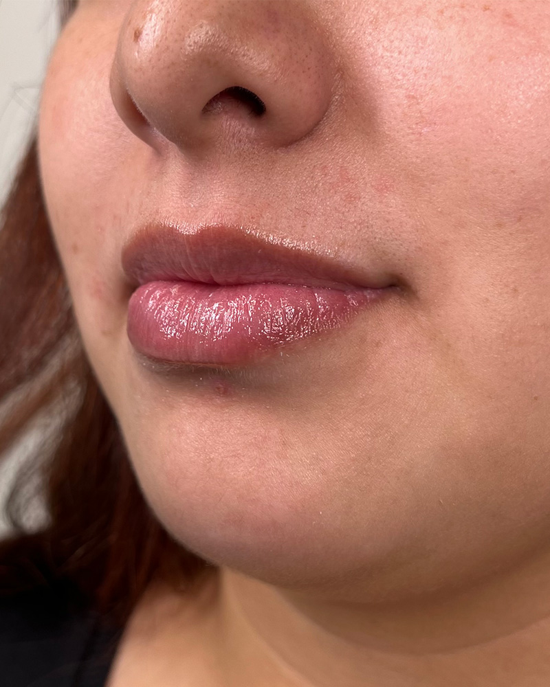 Labret Piercing Scar Hole